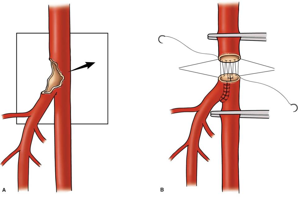 Vascular Thoracic Key