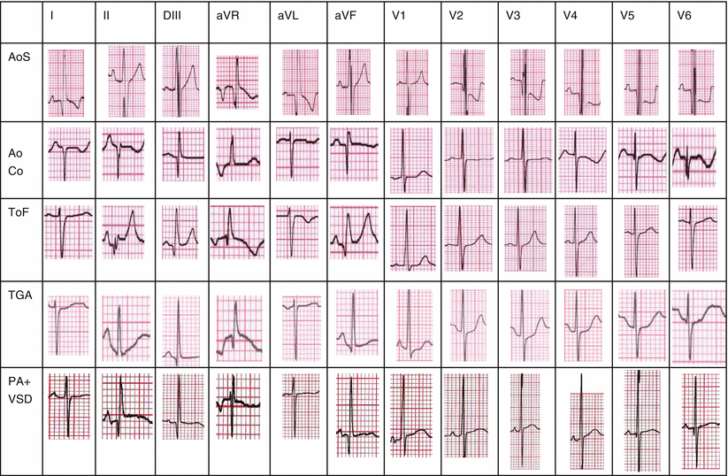 Congenital Heart Disease | Thoracic Key