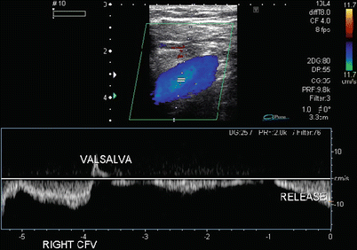 Color Venous Duplex Ultrasound of the Lower Extremity in the Diagnosis ...