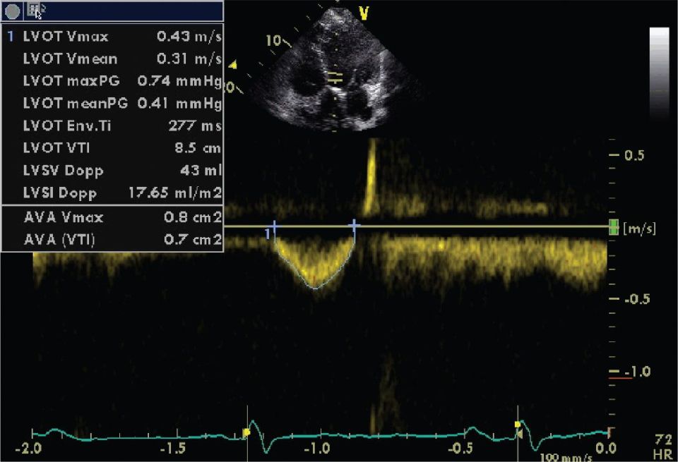 Echocardiographic Assessment of Valvular Heart Disease | Thoracic Key