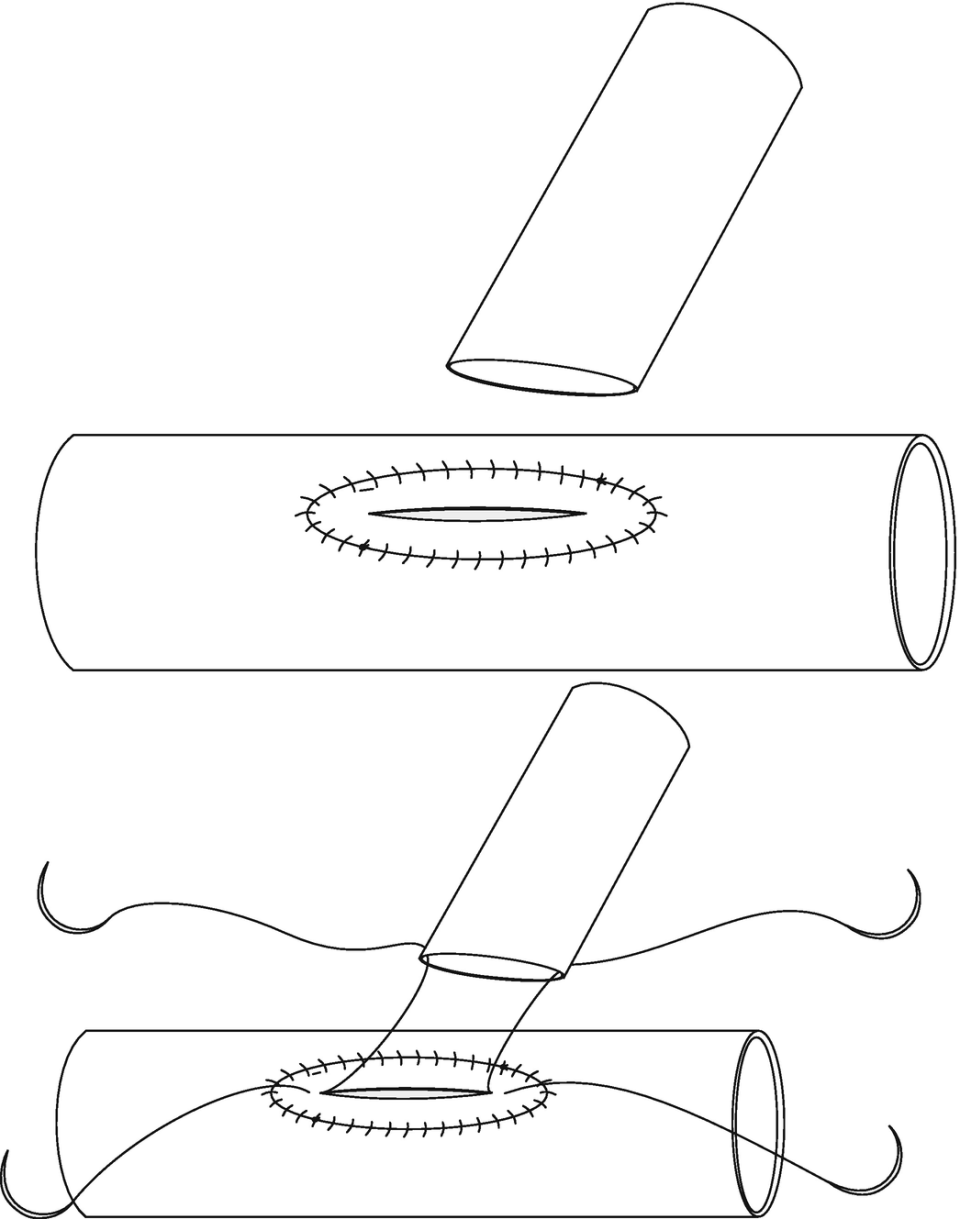 Prosthetic Bypass With A Distal Vein Patch For Limb Salvage – MRFBK