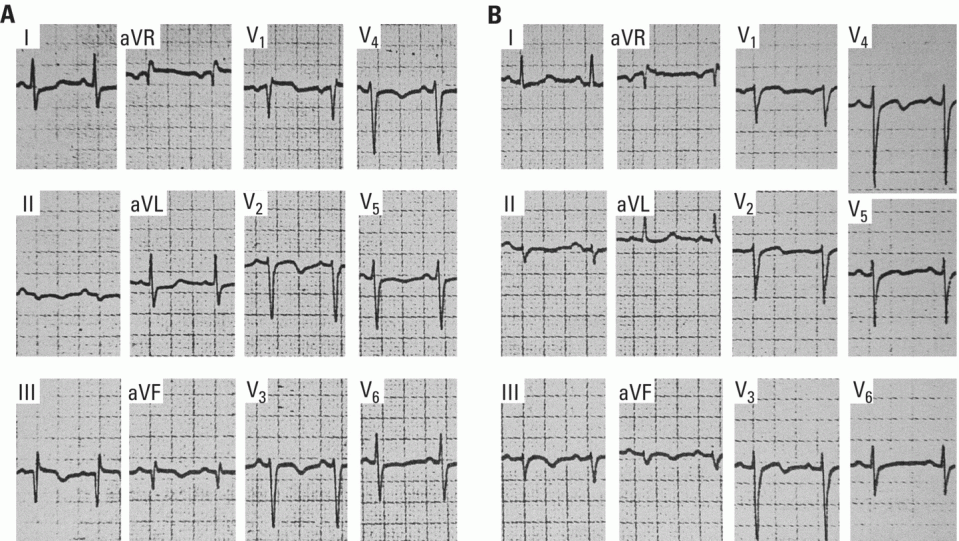 Ventricular Enlargement | Thoracic Key