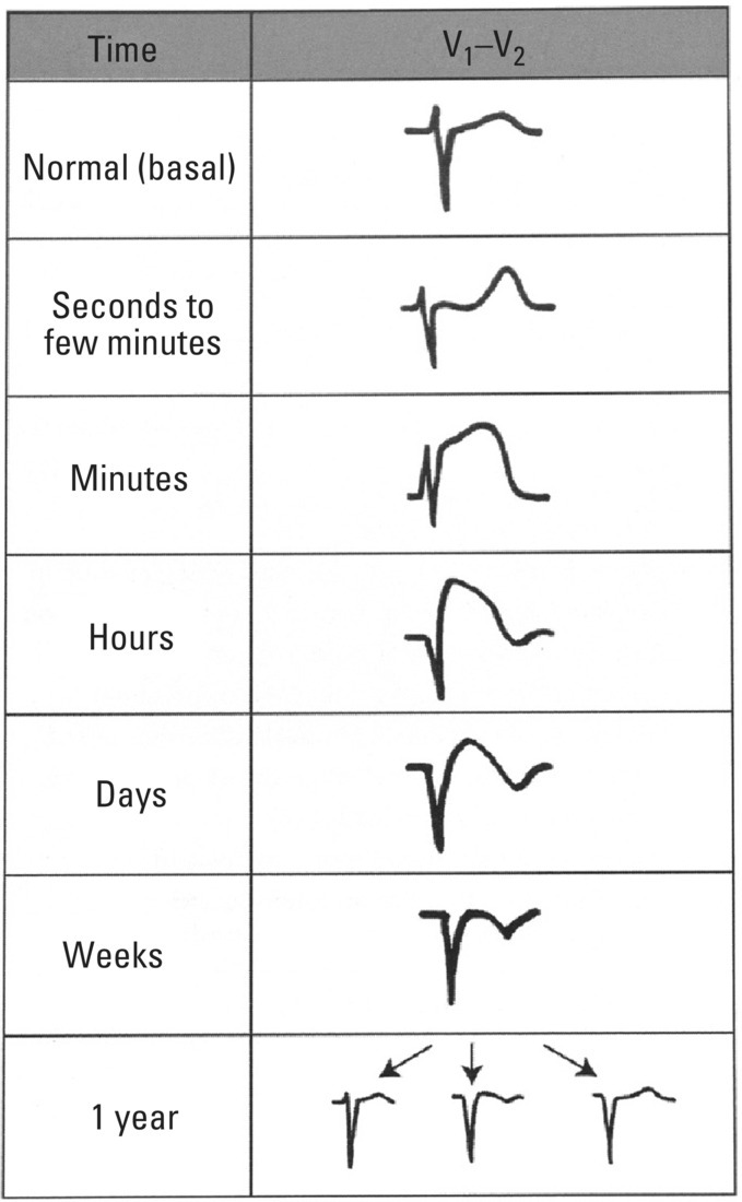 Ischemia and Necrosis | Thoracic Key