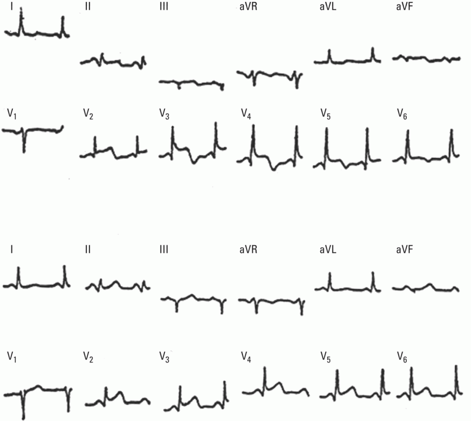 The ECG in Other Diseases and Different Situations | Thoracic Key