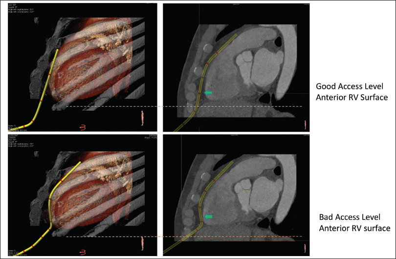 Epicardial Access for Left Atrial Appendage Occlusion: Techniques and ...