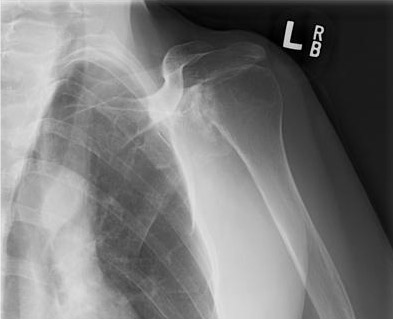 High Riding Shoulder joint | Radiology Notes