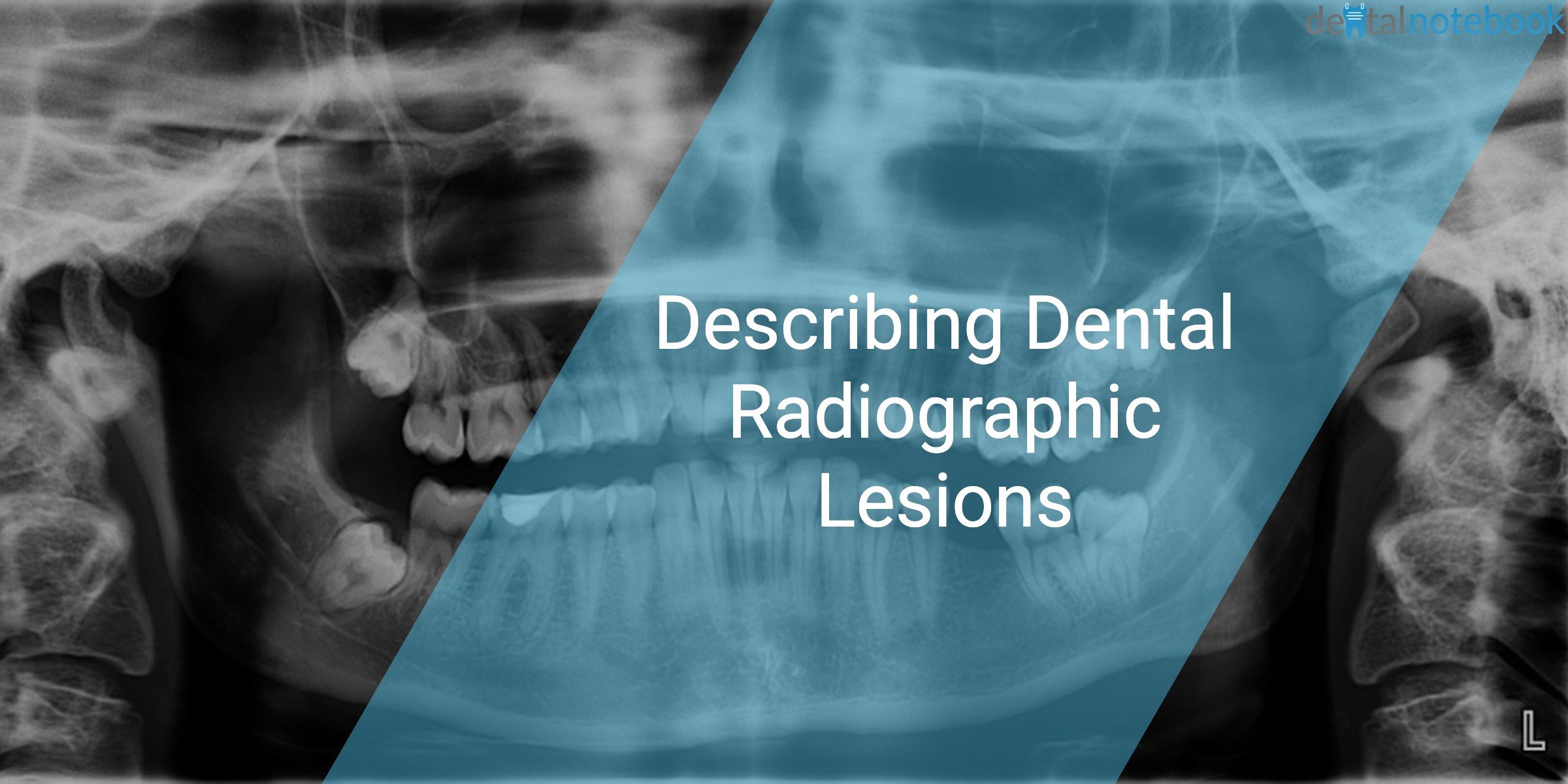 Describing Dental Radiographic Lesions - dentalnotebook