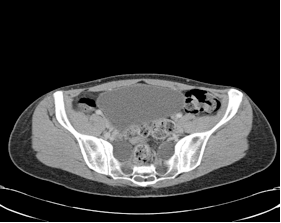 An Unusual Cause of Pelvic Pain - emdocs