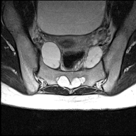 An Unusual Cause of Pelvic Pain - emdocs
