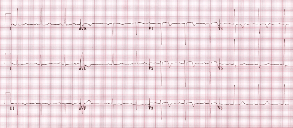Wellens' Syndrome - emdocs