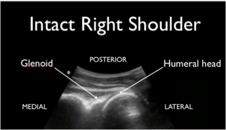 Shoulder Ultrasound: Intra-Articular Injection and Reduction - emdocs