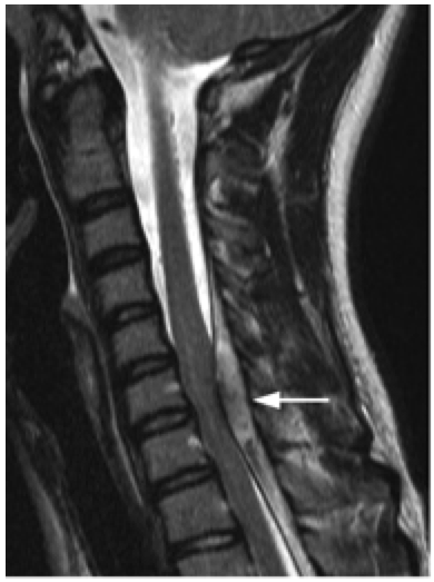 Spinal Epidural Hematoma