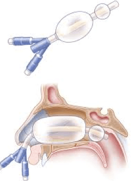 The Emergency Department Management of Posterior Epistaxis - emdocs