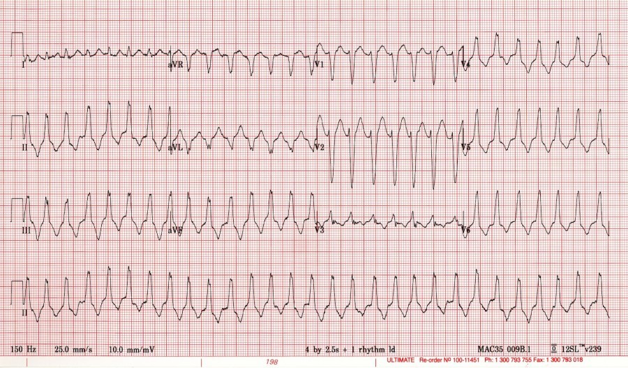 Tachycardic Arrhythmias in Pregnancy: Management - emdocs