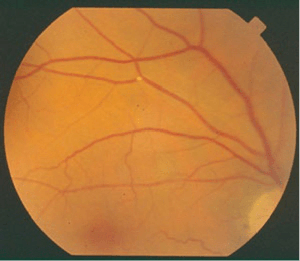 Sudden Loss of Vision – OPTOMETRY EVOLUTION