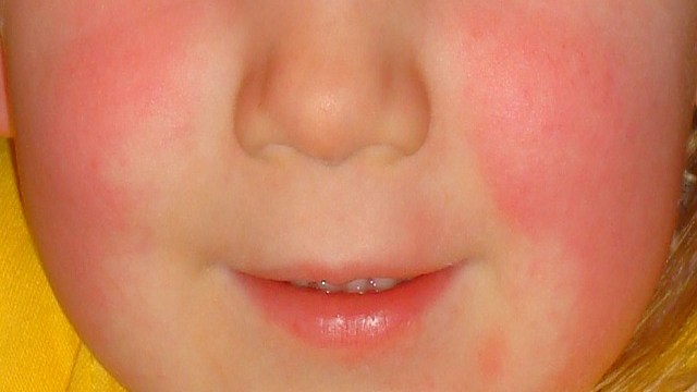 Geloni nei bambini: sintomi e rimedi - Passione Mamma