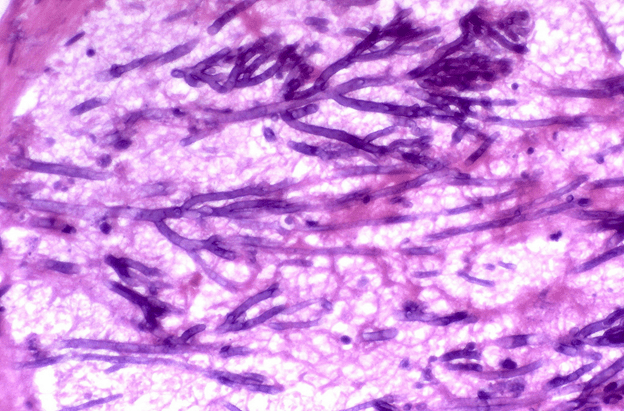 Fungal Infections & Antifungal Treatments | Stomp On Step1