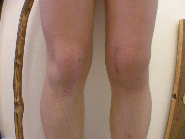 Home Remedies For Swollen Knees home-remedies-for-swollen-knees